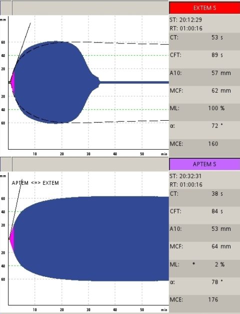 case report ROTEM - obsgynaecritcare