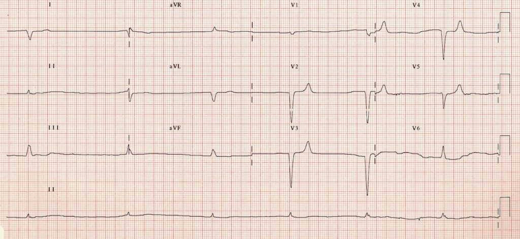 011 Hyperkalaemic crisis in the pre-eclamptic patient - obsgynaecritcare