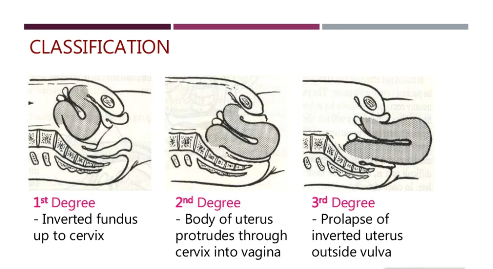 141 Uterine inversion with Dr David Owen - obsgynaecritcare